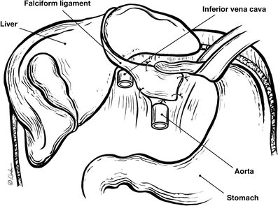 Use of the Falciform Ligament Flap for Closure of the Esophageal Hiatus ...
