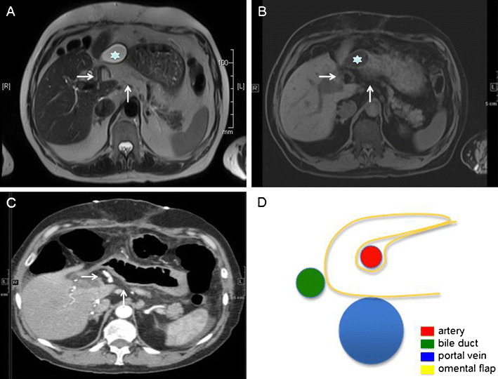 Omental Flap for Hepatic Artery Coverage During Liver Transplantation ...
