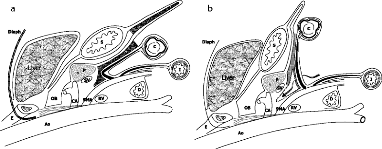 Inframesocolic Superior Mesenteric Artery First Approach as an ...
