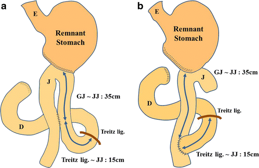 Comparison Between Billroth-II with Braun and Roux-en-Y Reconstruction ...