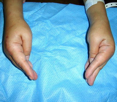 Anorexia Nervosa: Russell’s Sign with Concurrent Tetany | SpringerLink