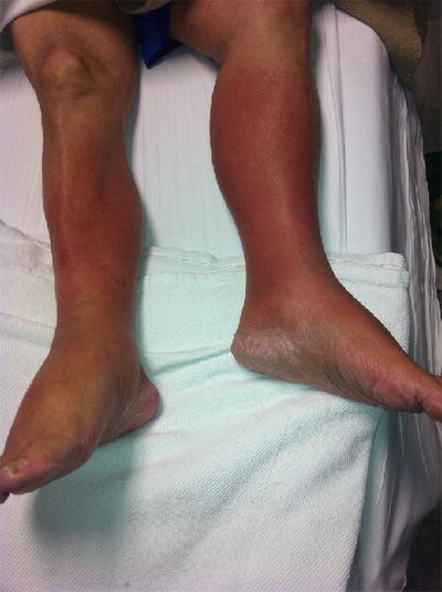 Gemcitabine Associated Pseudocellulitis | SpringerLink