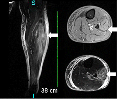 Risking Life and Limb: A Case of Spontaneous Diabetic Muscle Infarction ...