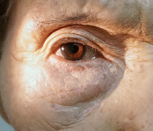 Oblique Flashlight Test: Lighting Up Acute Angle-Closure Glaucoma ...