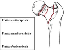 L’utilizzo della protesi d’anca nel trattamento delle fratture del ...