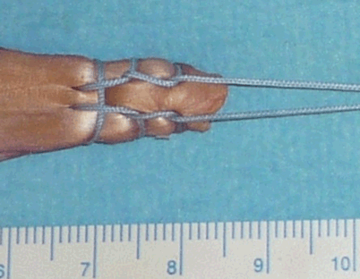 LBS-Tenotomie oder LBS-Tenodese? | SpringerLink