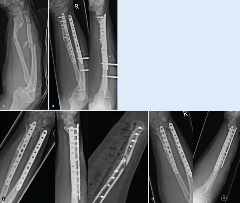 Unterarmschaftfrakturen beim Erwachsenen | SpringerLink