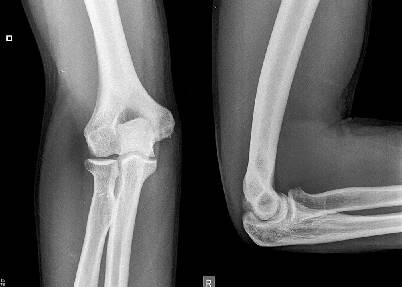 Valgus instability of the elbow: acute and chronic form | SpringerLink