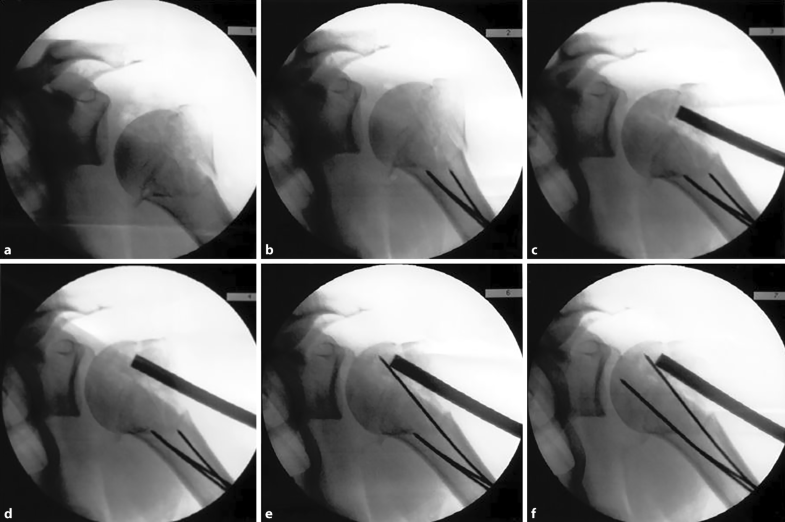 Head-split fractures of the proximal humerus | SpringerLink