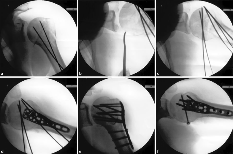 Head-split fractures of the proximal humerus | SpringerLink
