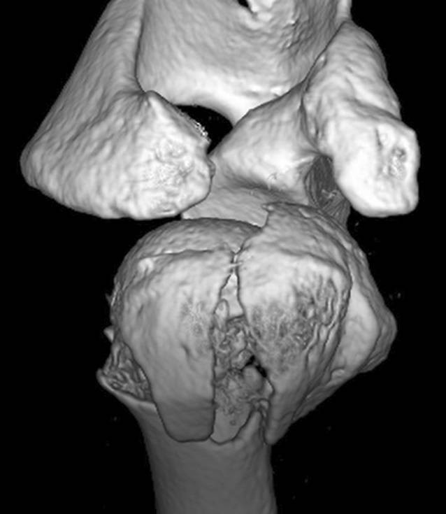 Head-split fractures of the proximal humerus | SpringerLink