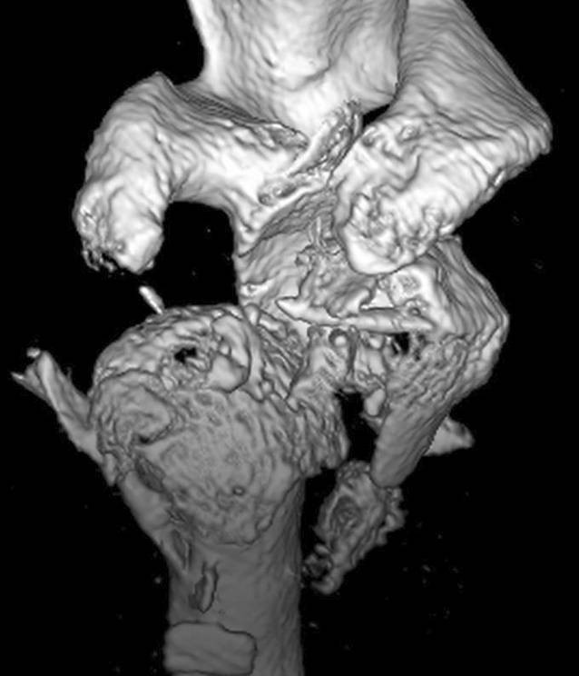Head-split fractures of the proximal humerus | SpringerLink