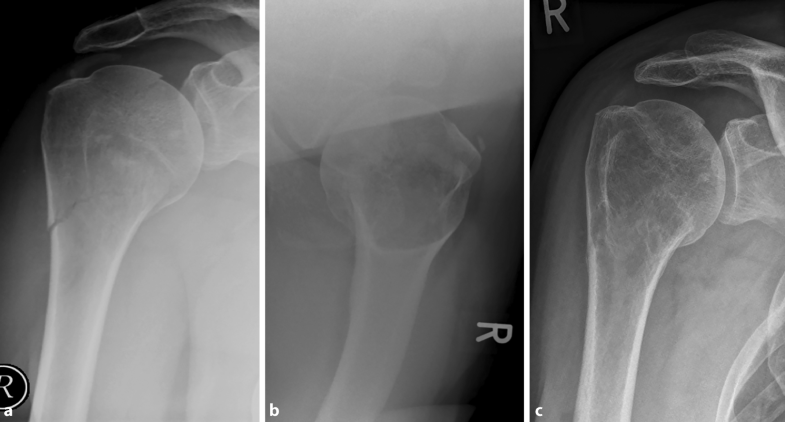 Head-split fractures of the proximal humerus | SpringerLink