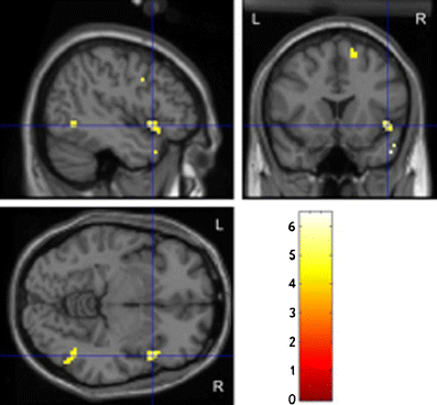 Mirror neuron activity during contagious yawning—an fMRI study ...