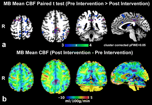 Methylene blue modulates functional connectivity in the human brain ...
