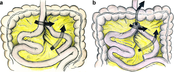 Small Bowel Obstruction and Internal Hernias during Pregnancy after ...