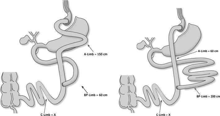 Gastric Bypass with Long Alimentary Limb or Long Pancreato-Biliary Limb ...