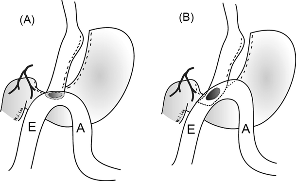 Single-Anastomosis Gastric Bypass (SAGB): Appraisal of Clinical ...