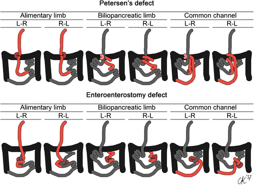 Diagnosing Internal Herniation After Roux-en-Y Gastric Bypass Surgery ...