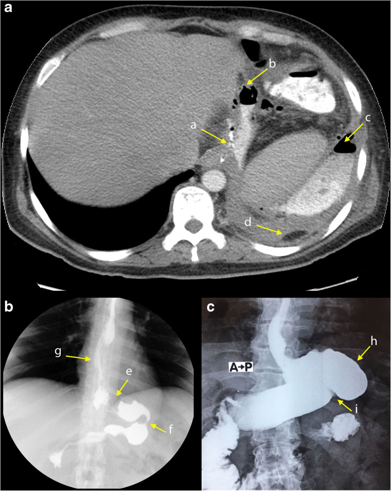 Imaging after Bariatric Surgery: When Interpretation Is a Challenge ...