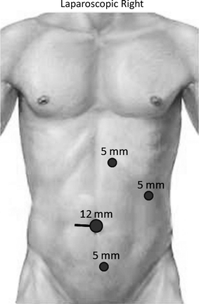 Laparoscopic versus robotic right colectomy: a single surgeon’s experience | SpringerLink