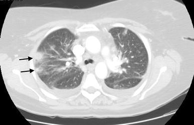 Endocarditis with pulmonary and systemic embolization | SpringerLink