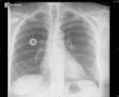 Pinch-off syndrome: a simple test is the best | SpringerLink