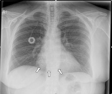 Pinch-off syndrome: a simple test is the best | SpringerLink