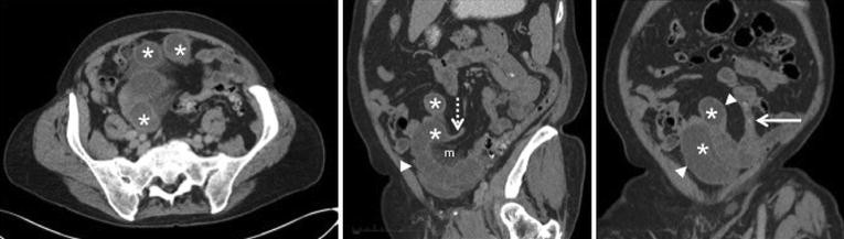 Classic signs of closed loop bowel obstruction | SpringerLink