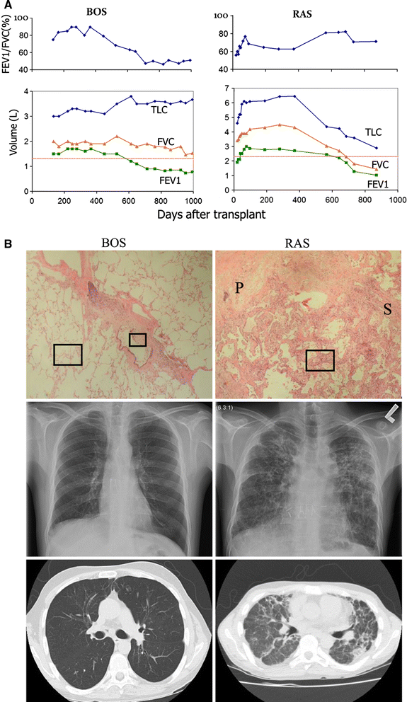 Chronic lung allograft dysfunction after lung transplantation: the ...