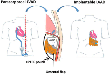 Clinical management for complications related to implantable LVAD use ...