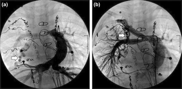 Clinical outcomes of early scheduled Fontan completion following ...