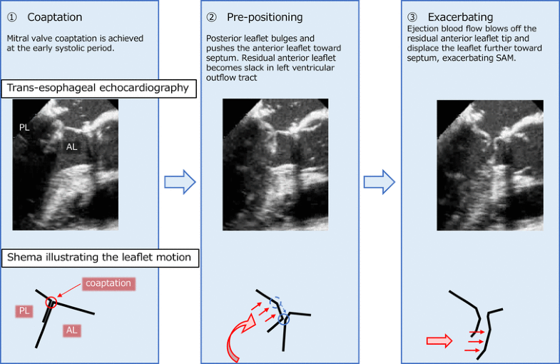 Management of systolic anterior motion of the mitral valve: a mechanism ...