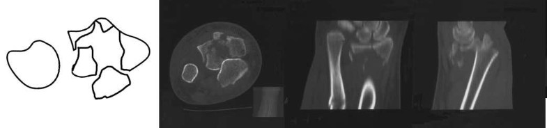 The treatment of severely comminuted intra-articular fractures of the ...