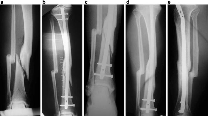 Reamed interlocking intramedullary nailing for the treatment of tibial diaphyseal fractures and ...