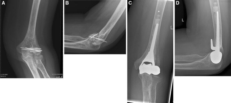 Distal humerus prosthetic hemiarthroplasty: midterm results | SpringerLink