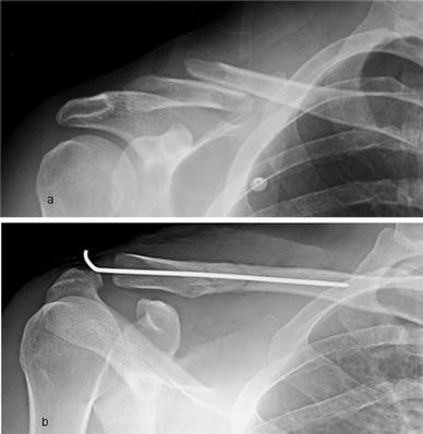 Midshaft clavicle fractures treatment: threaded Kirschner wire versus ...