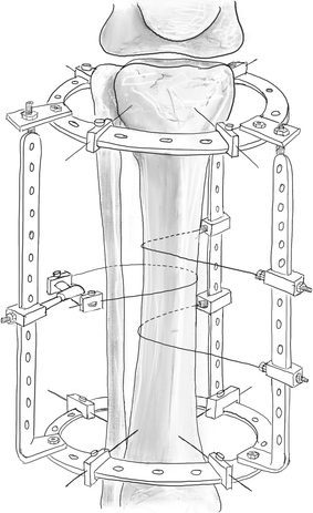 The history, evolution and basic science of osteotomy techniques ...