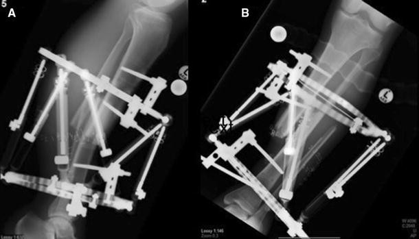 The tibial bayonet method of wound closure | SpringerLink