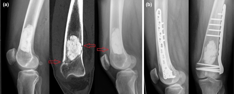 Surgical therapy of benign and low-grade malignant intramedullary ...
