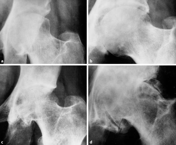 Arthrose | SpringerLink