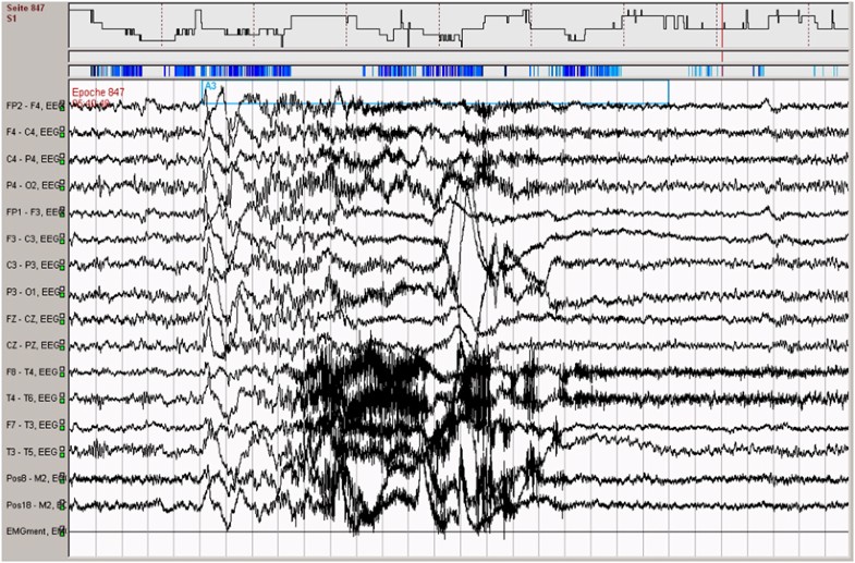 „Cyclic alternating pattern“ | SpringerLink