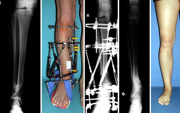Accuracy of complex lower-limb deformity correction with external ...