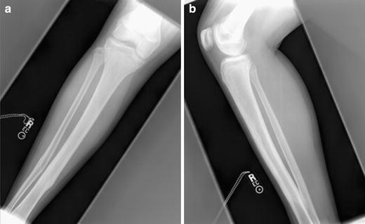 Titanium elastic nails for pediatric tibial shaft fractures | SpringerLink