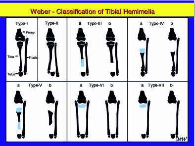 New classification and score for tibial hemimelia | SpringerLink