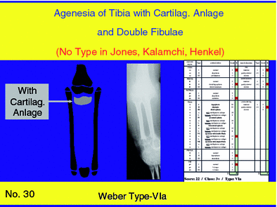 New classification and score for tibial hemimelia | SpringerLink