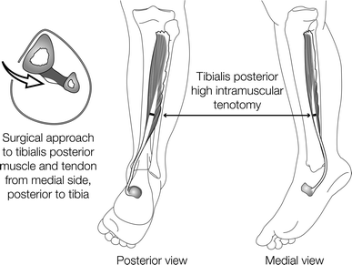 The effects of intramuscular tenotomy on the lengthening ...