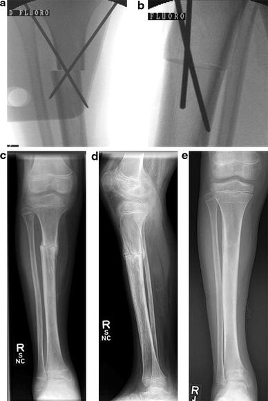Proximal tibial derotation osteotomy for torsion of the tibia: a review ...