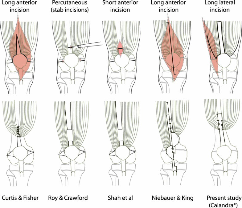 Quadricepsplasty for congenital dislocation of the knee and congenital ...