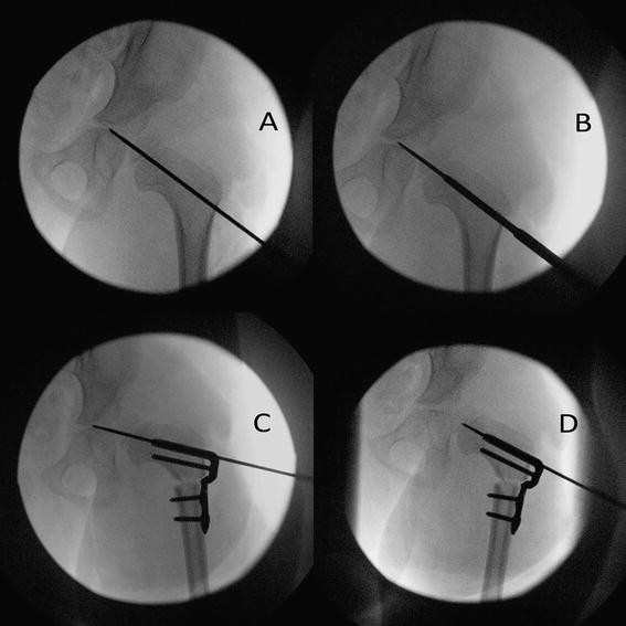 Cannulated, locking blade plates for proximal femoral osteotomy in ...